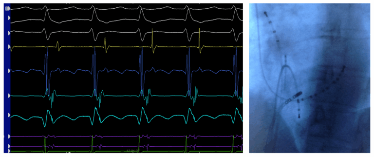Taquicardia paroxística supraventricular (TPSV) - Instituto de Arritmias