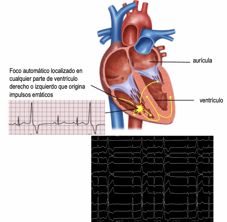 EXTRASISTOLES VENTRICULARES - Instituto de Arritmias