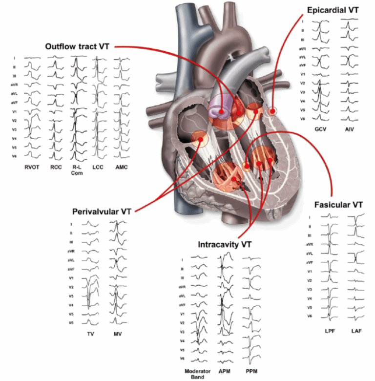 EXTRASISTOLES VENTRICULARES - Instituto de Arritmias