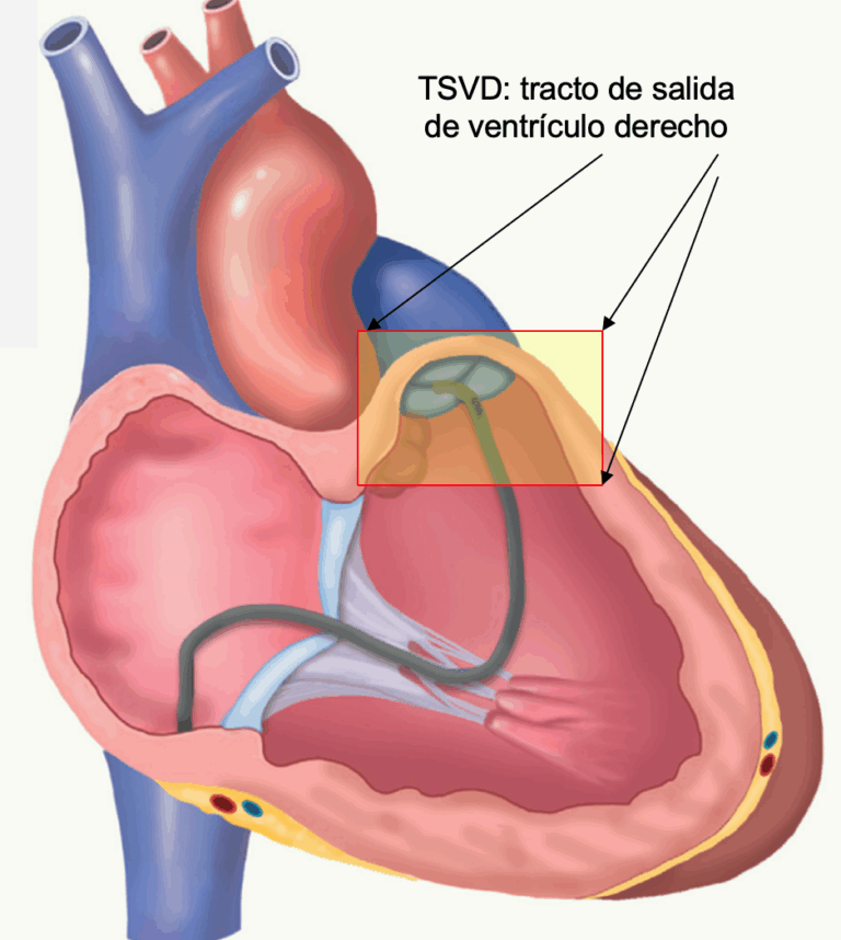EXTRASISTOLES VENTRICULARES - Instituto de Arritmias